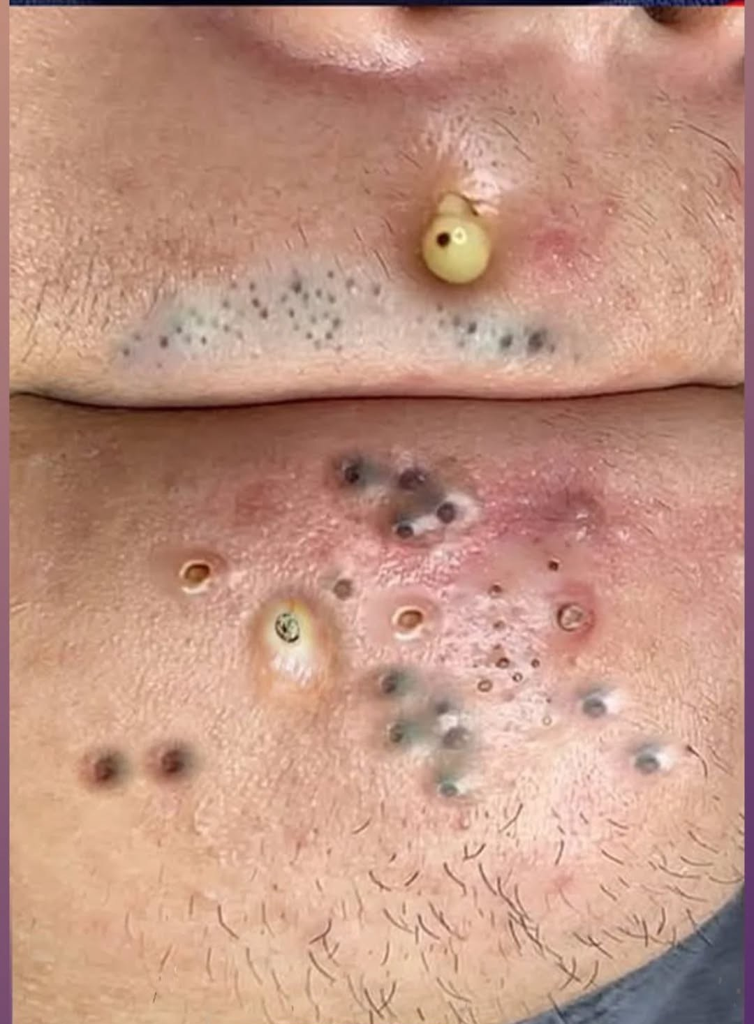 Severe Facial Comedones and Inflammatory Acne: Causes, Appearance, and ...