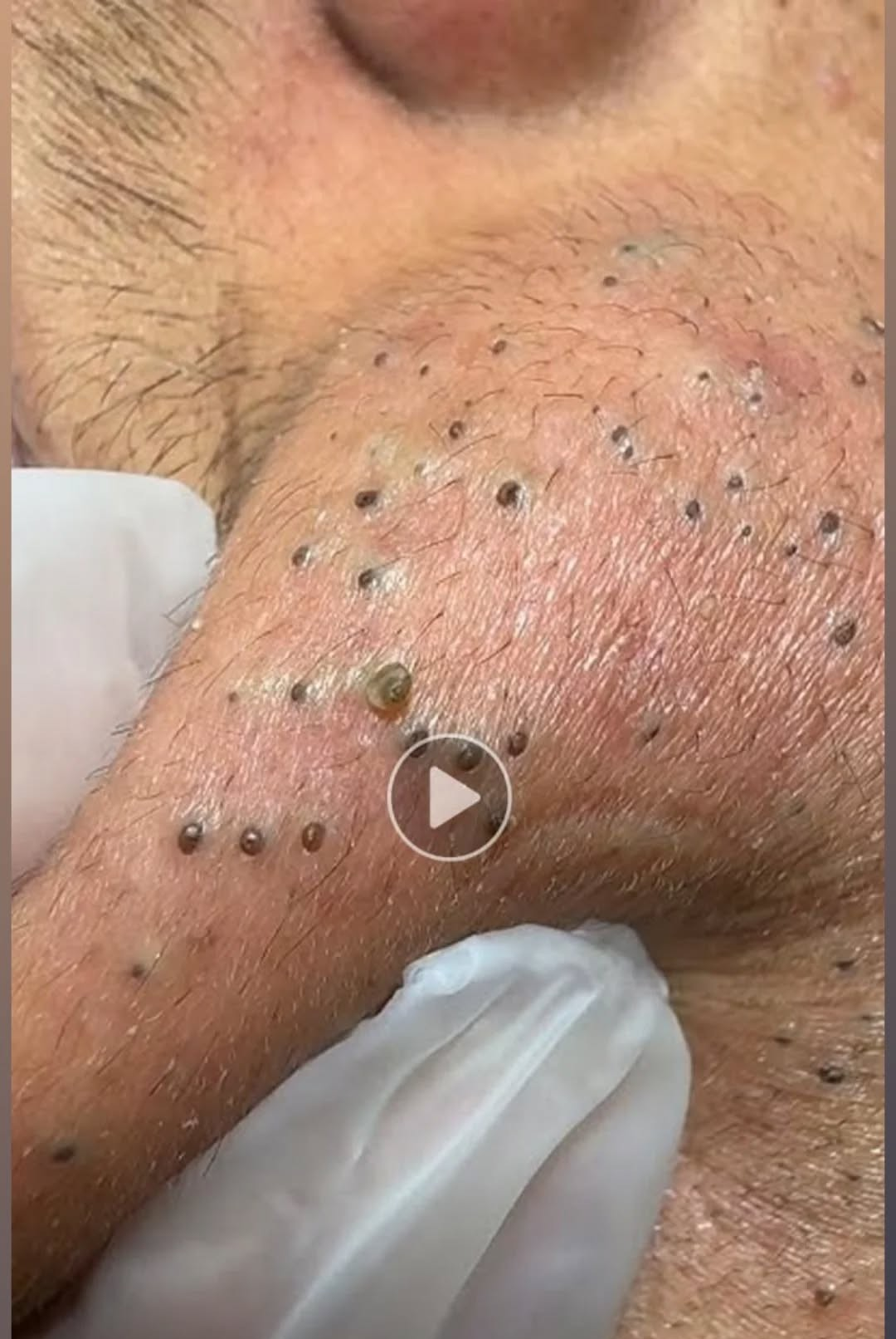 Severe Blackheads and Open Comedones: Causes, Appearance, and Proper ...